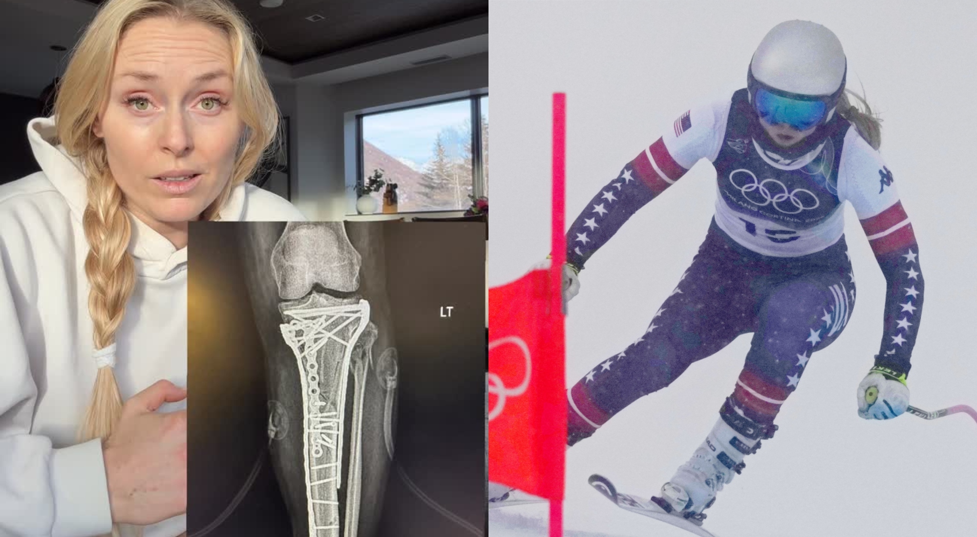 Lindsey Vonn Reveals How Torn ACL May Have Actually Saved Her Leg From ...